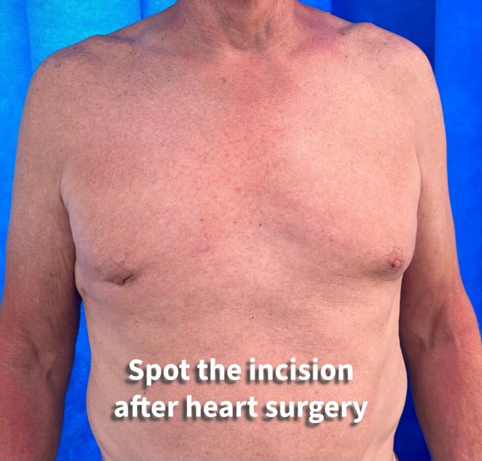 Is Keyhole Heart Surgery Safe ? - The Keyhole Heart Clinic